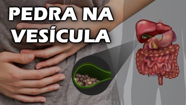 Pedra na vesícula, Sintomas, causas e tratamento! - Buscar Saúde Pedra na vesícula, Sintomas, causas e tratamento! - Buscar Saúde